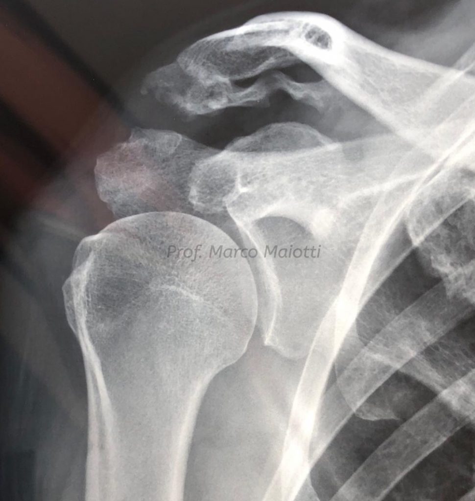 Lussazione Acromion Clavicolare Spalla - Prof. Marco Maiotti