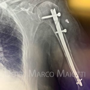 Frattura Omero Prossimale - Prof. Marco Maiotti